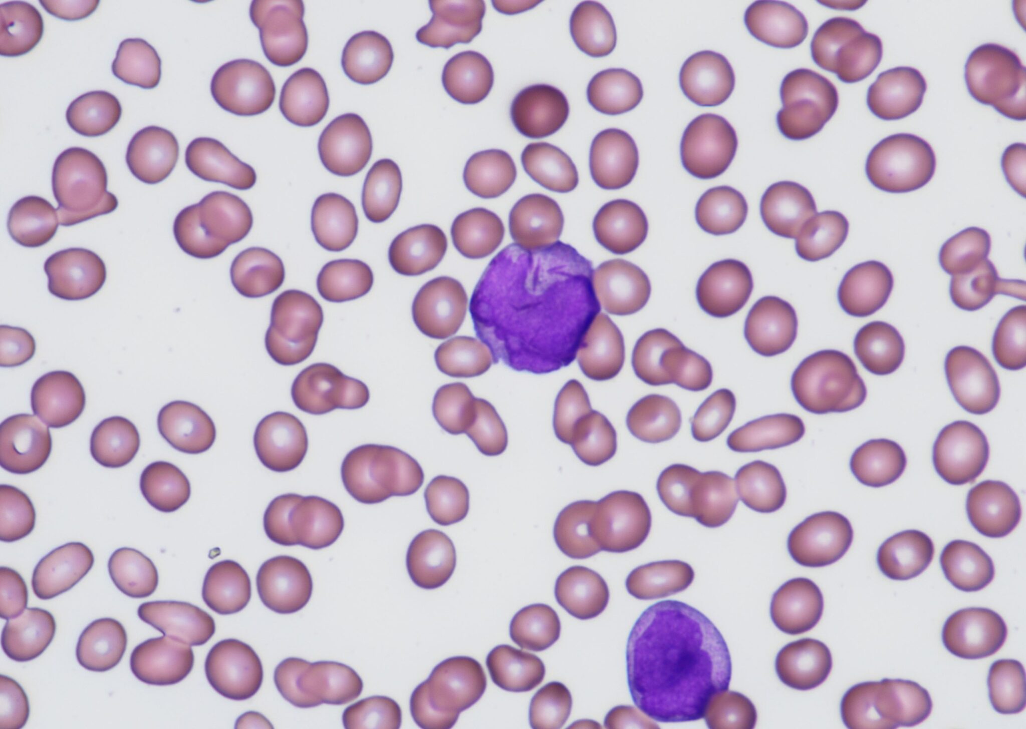 急性前骨髄球性白血病（acute promyelotic leukemia; APL (M3)) の塗抹像と組織像 – 病理の広場