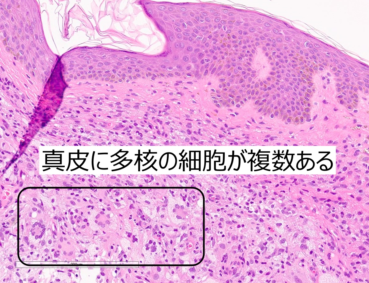 115D33 水仕事と類上皮細胞性肉芽腫、特徴的形態を示す多核巨細胞の名称について – 病理の広場