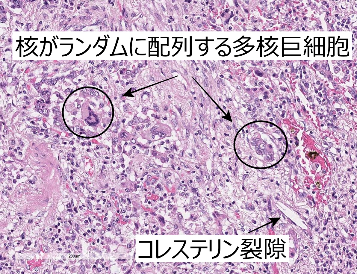 115D33 水仕事と類上皮細胞性肉芽腫、特徴的形態を示す多核巨細胞の名称について – 病理の広場