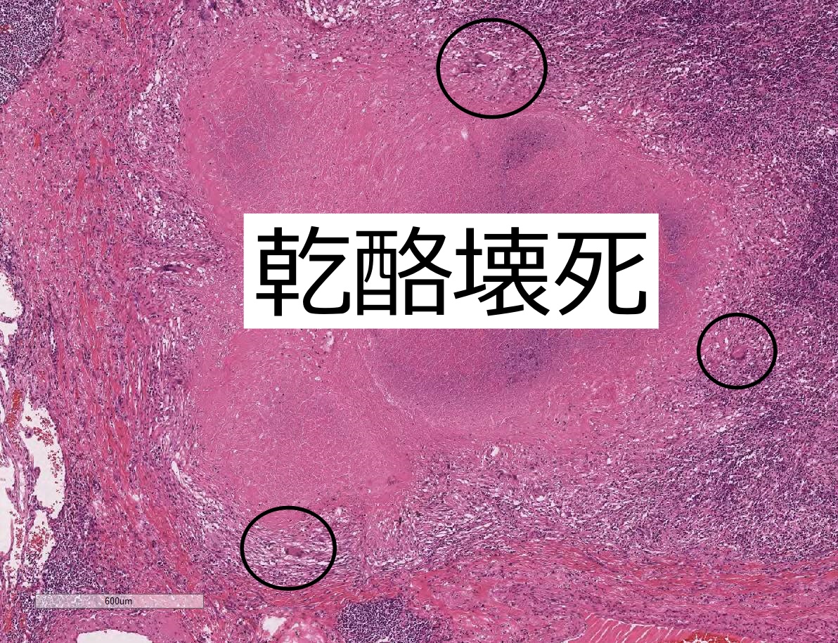 115D33 水仕事と類上皮細胞性肉芽腫、特徴的形態を示す多核巨細胞の名称について – 病理の広場