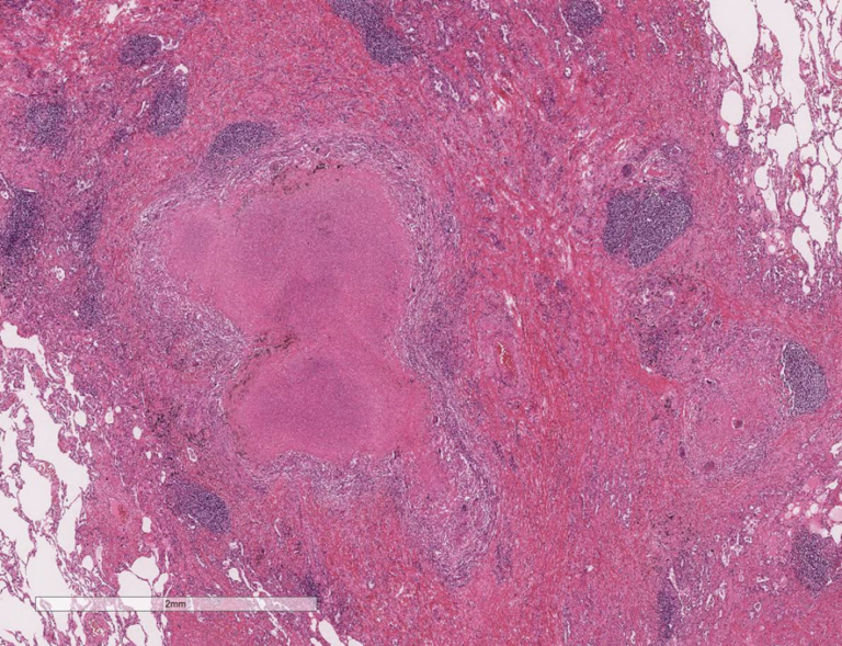 115D33 水仕事と類上皮細胞性肉芽腫、特徴的形態を示す多核巨細胞の名称について – 病理の広場