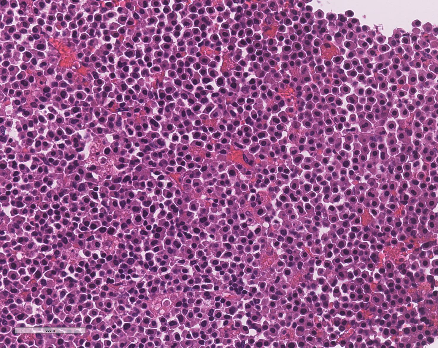 急性前骨髄球性白血病（acute promyelotic leukemia; APL (M3)) の塗抹像と組織像 – 病理の広場